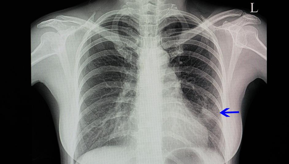 What Is White Lung Pneumonia? Before You Panic, Read This