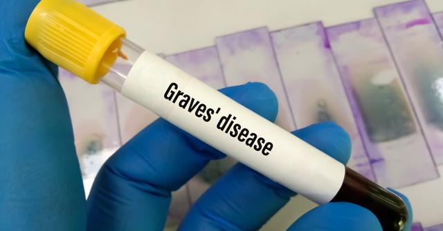 How Long Can You Live With Graves' Disease?