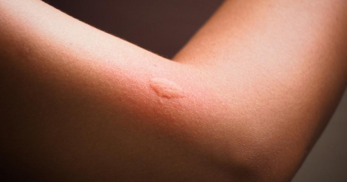 Spider Bite vs. Mosquito Bite: How to Identify
