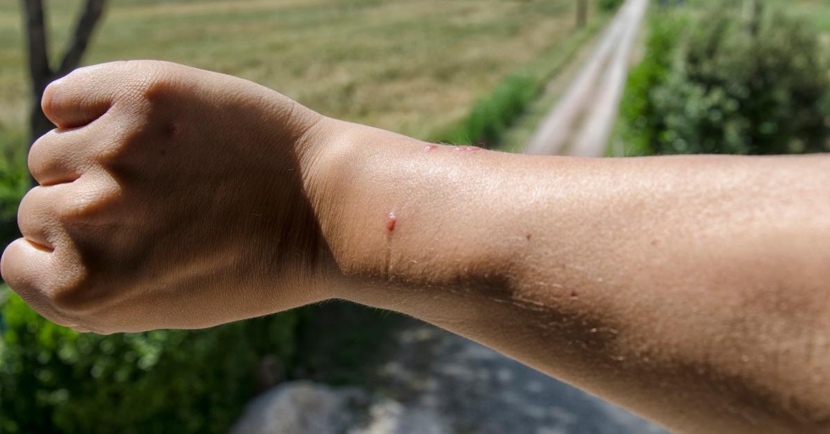 Spider Bite vs. Mosquito Bite: How to Identify