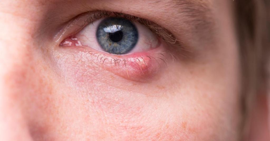 How to Prevent and Treat Styes — Naturally