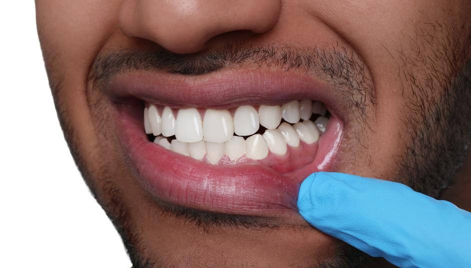 Is Sparkling Water Bad for Your Teeth? Details Here