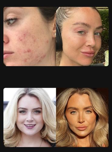 What Is Cortisol Face aka Moon Face? Details on the Viral Phrase