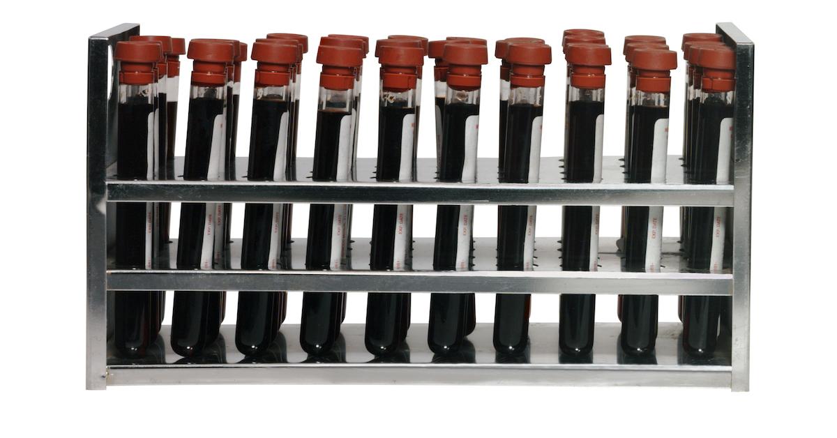 Patients of "Mystery Disease" in India Have Nickel in Their Blood