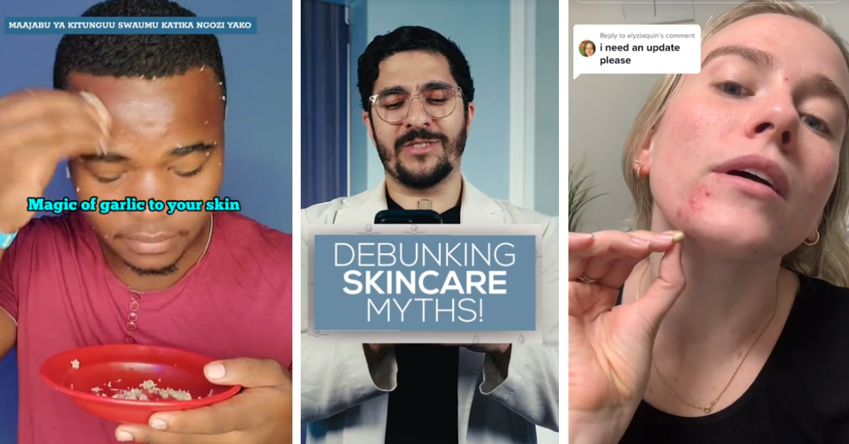 Will Rubbing Garlic on Your Face Help Your Acne?