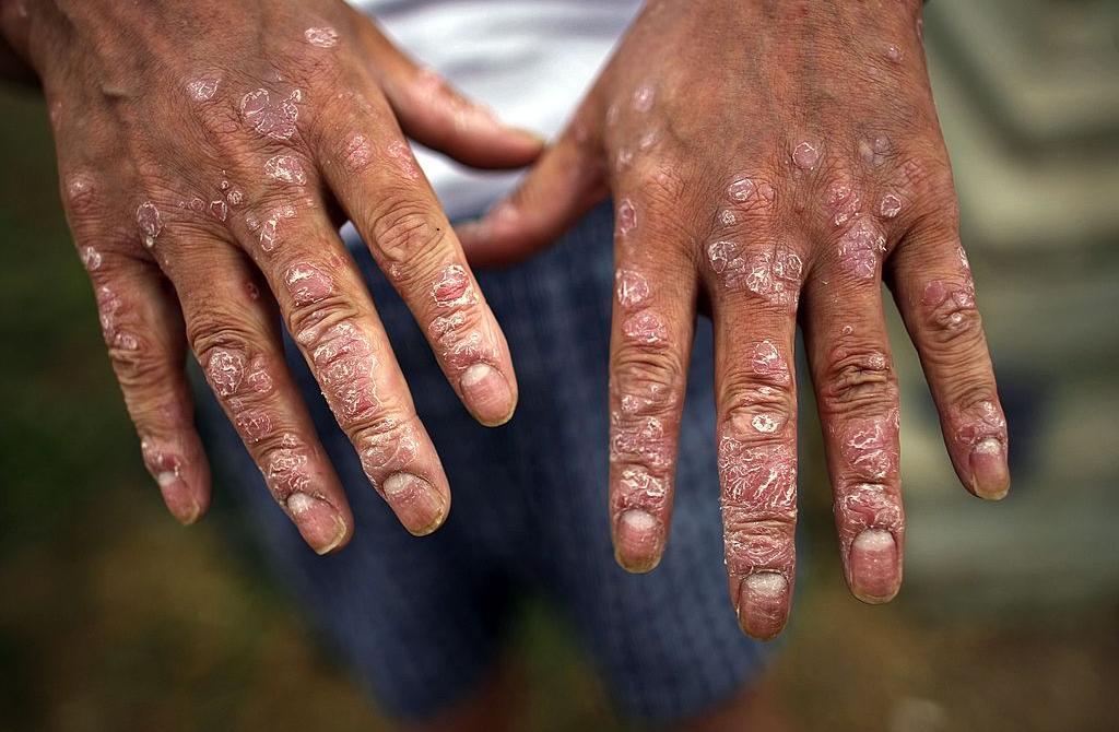 Agent Orange and Its Environmental Impact: What You Should Know