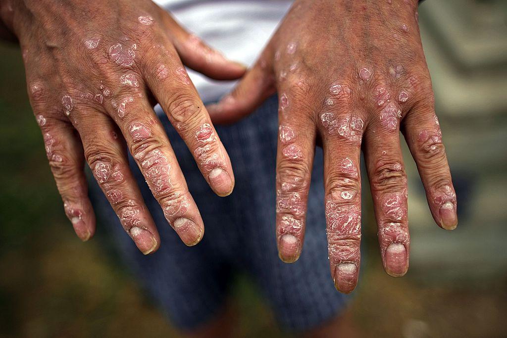 Agent Orange and Its Environmental Impact: What You Should Know